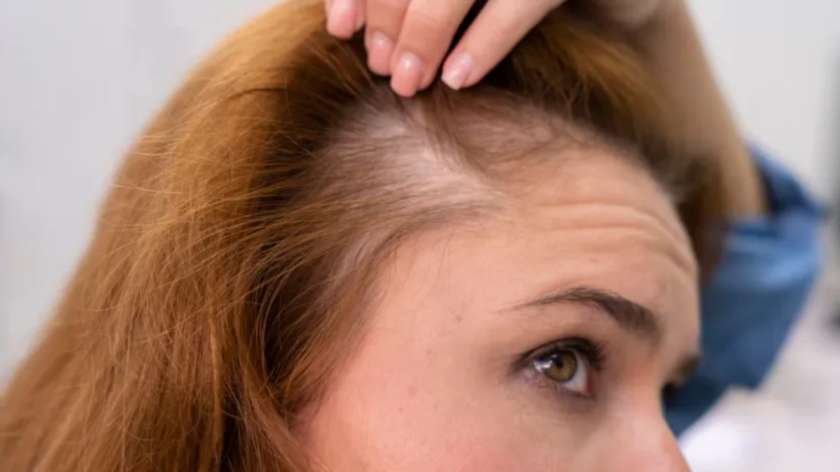 Which vitamin deficiency causes hair fall? Know ways to overcome
