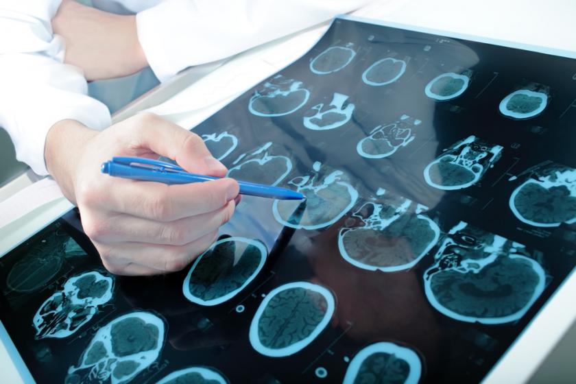 Simple brain scan could improve Parkinson's treatment | Lifestyle News ...