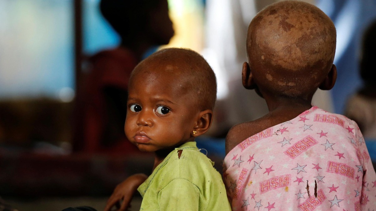 Obesity rises as malnutrition declines by 1% every year in India ...