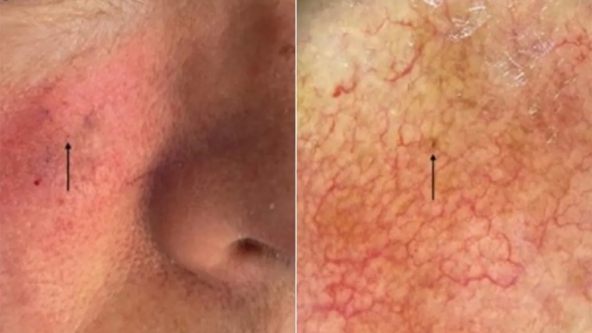 World's smallest skin cancer 'almost invisible spot' detected under ...