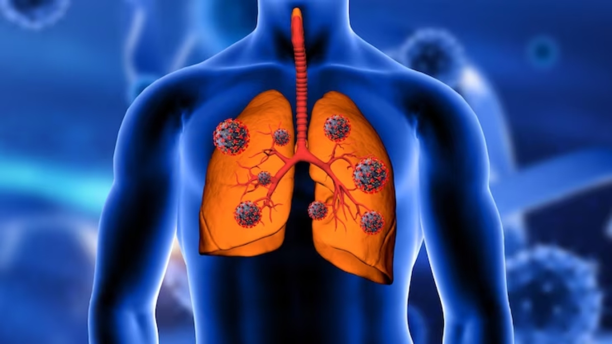 What are the types of lung cancer? Know symptoms, causes and treatments ...