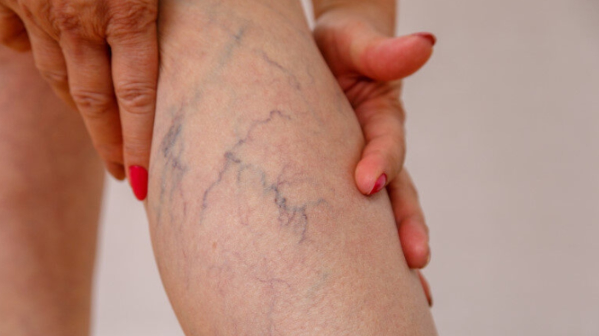 What is Varicose Veins? Know symptoms, causes and treatment of this common condition | Health ...