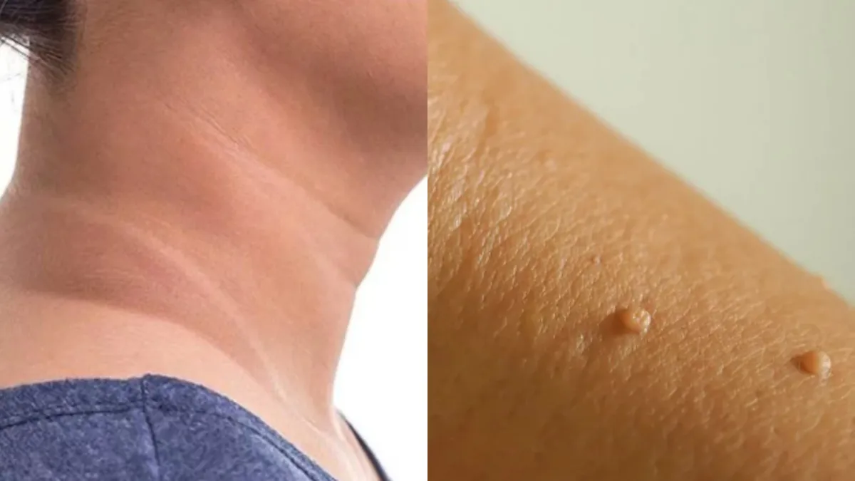 Dark neck and skin warts? THIS disease can be the reason, know ...
