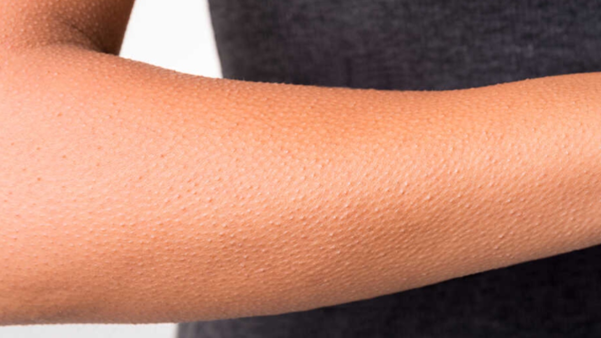 Do you have strawberry skin? Know causes and prevention tips for ...