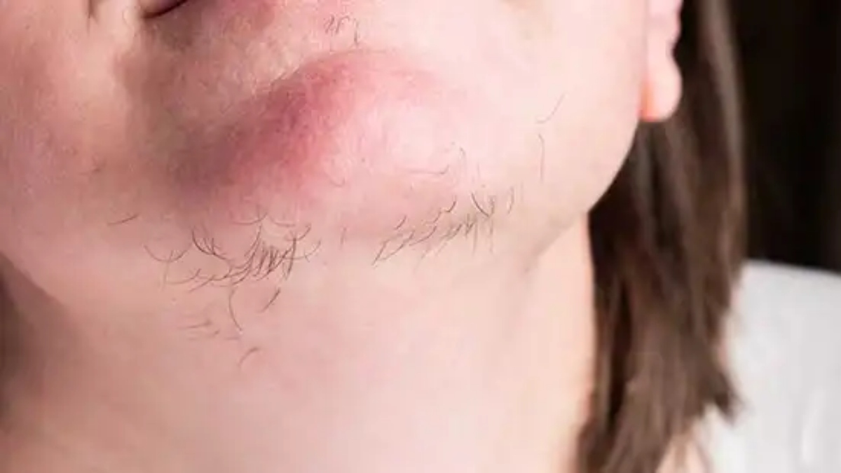 Unwanted hair starts growing on women's body, know causes and ways to ...