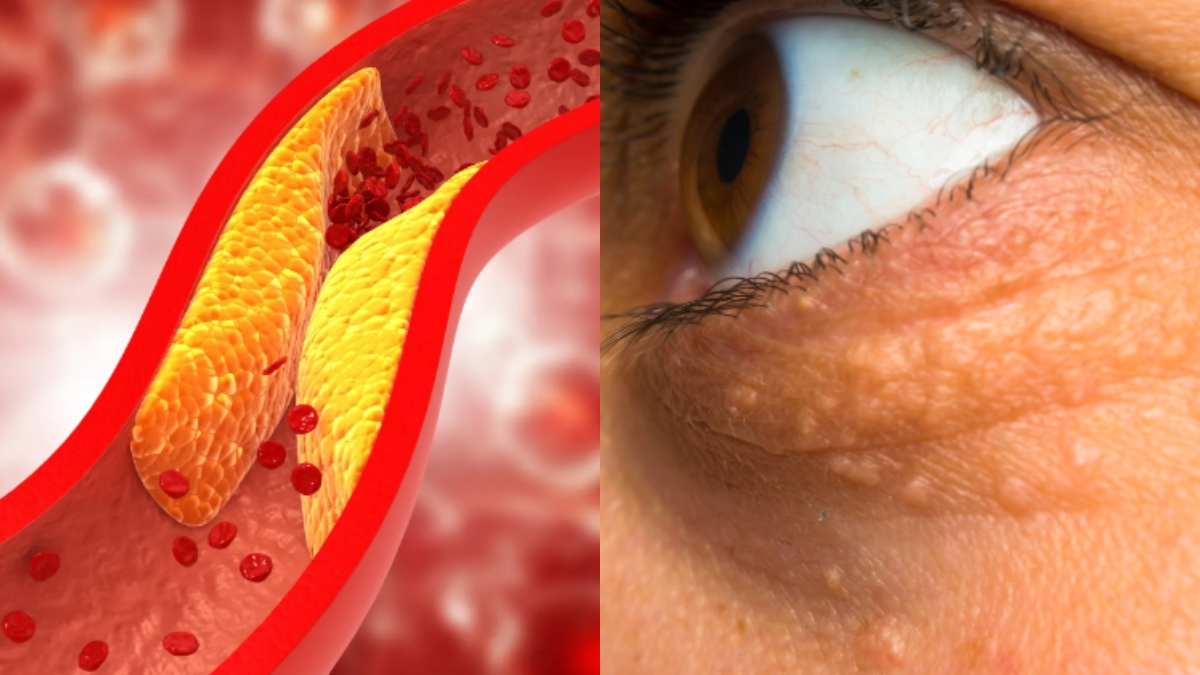 High cholesterol symptoms: 5 signs that appear on skin when cholesterol ...