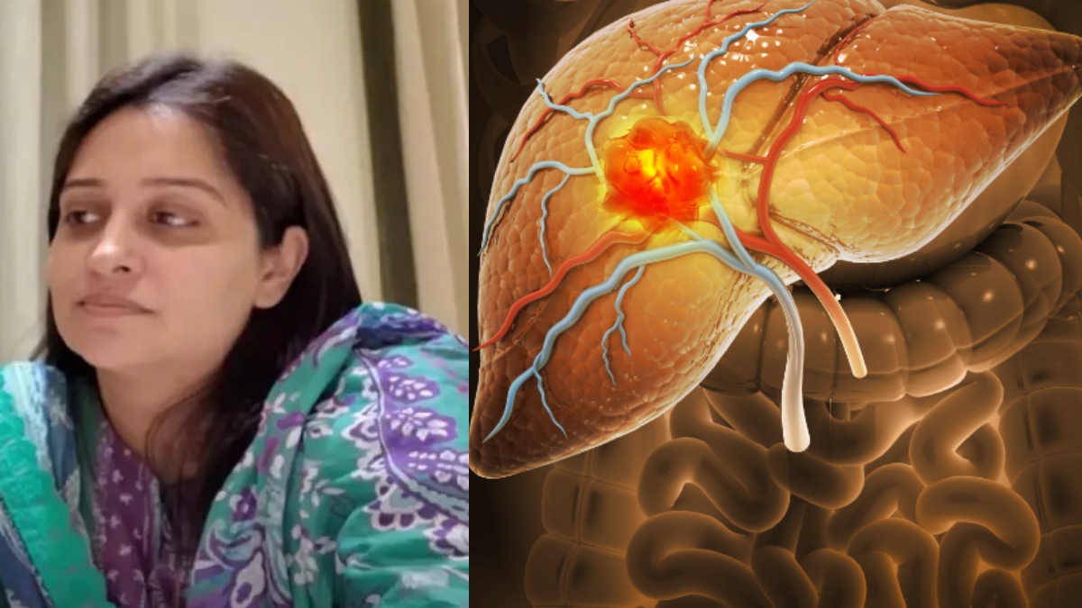 Dipika Kakar diagnosed with stage 2 liver cancer: Know causes, early signs, life expectancy and ...