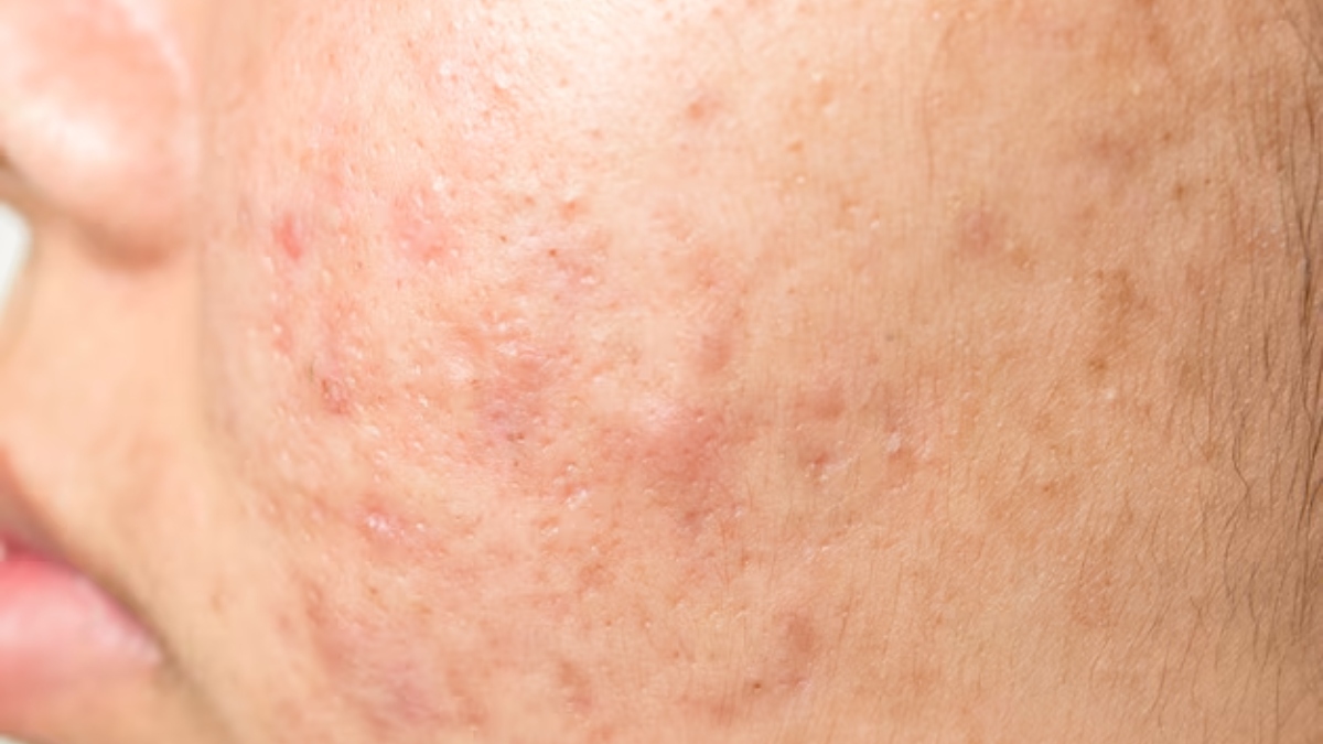 Struggling with sudden breakouts? These doctor-approved tips can help ...