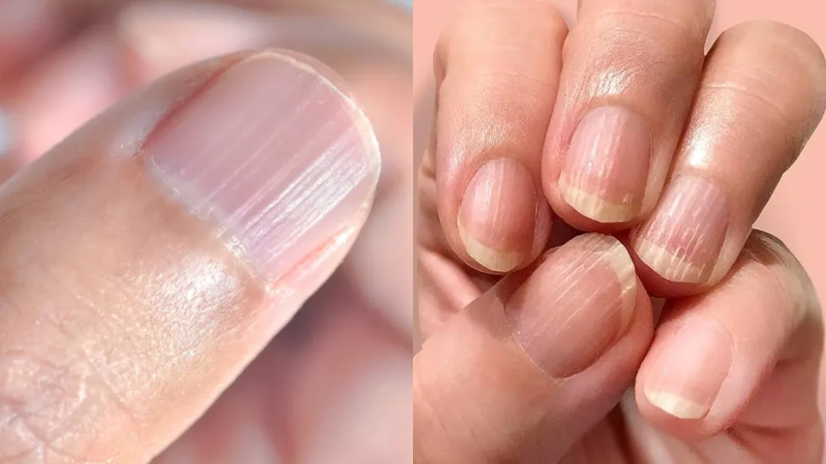 What do the lines on the nails indicate? Know which deficiency it can ...