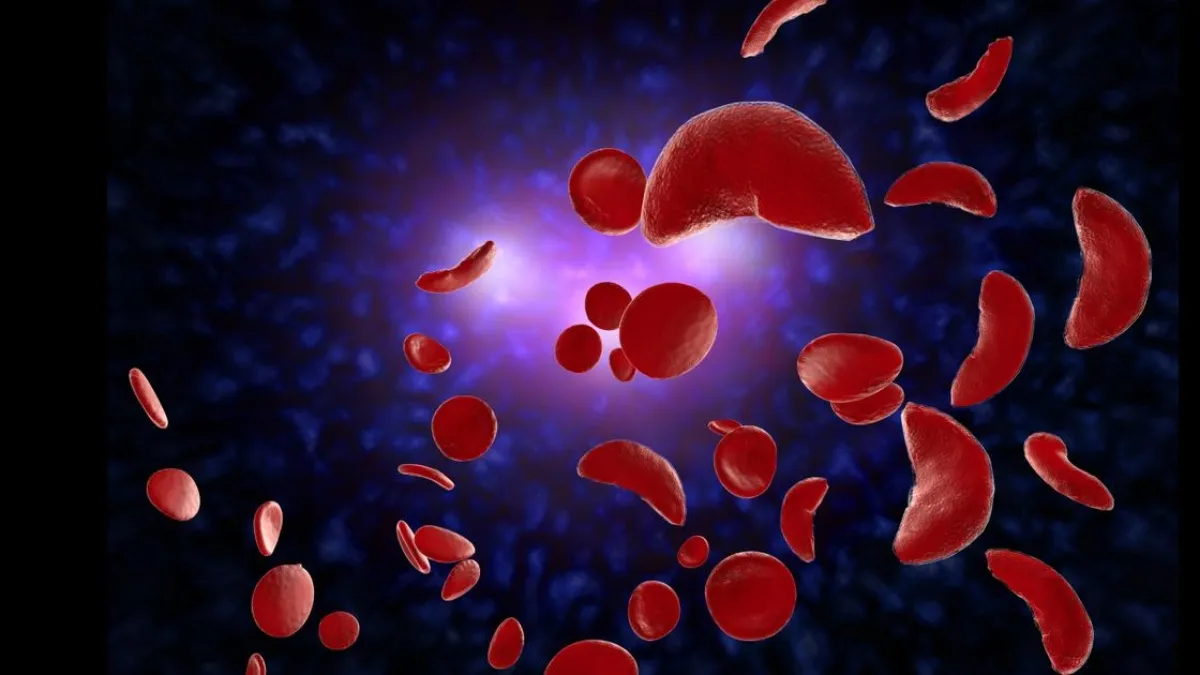 World Sickle Cell Day 2025: What is Sickle Cell Anaemia? Doctor debunks ...