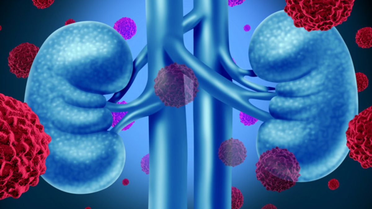 Understanding Metastatic Renal Cell Carcinoma: Doctor explains how ...