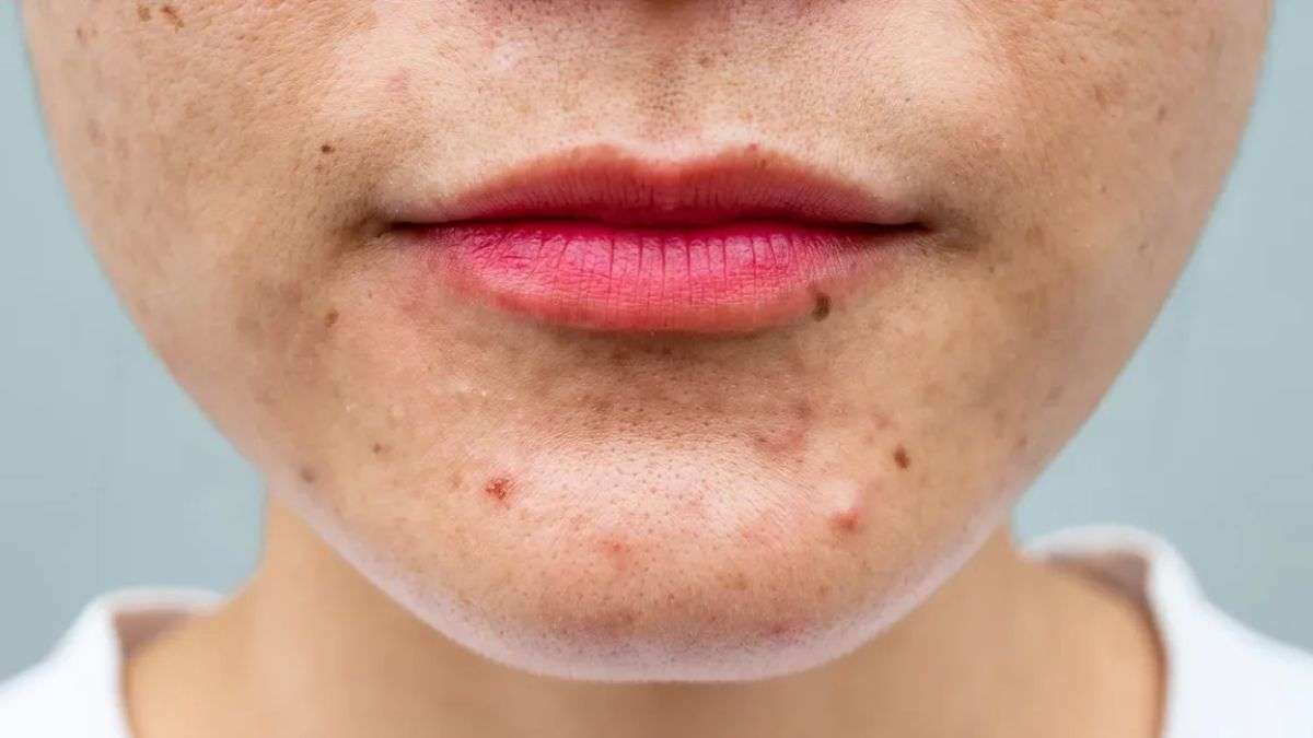 Are you suffering from acne on the chin? Expert reveals what causes it ...