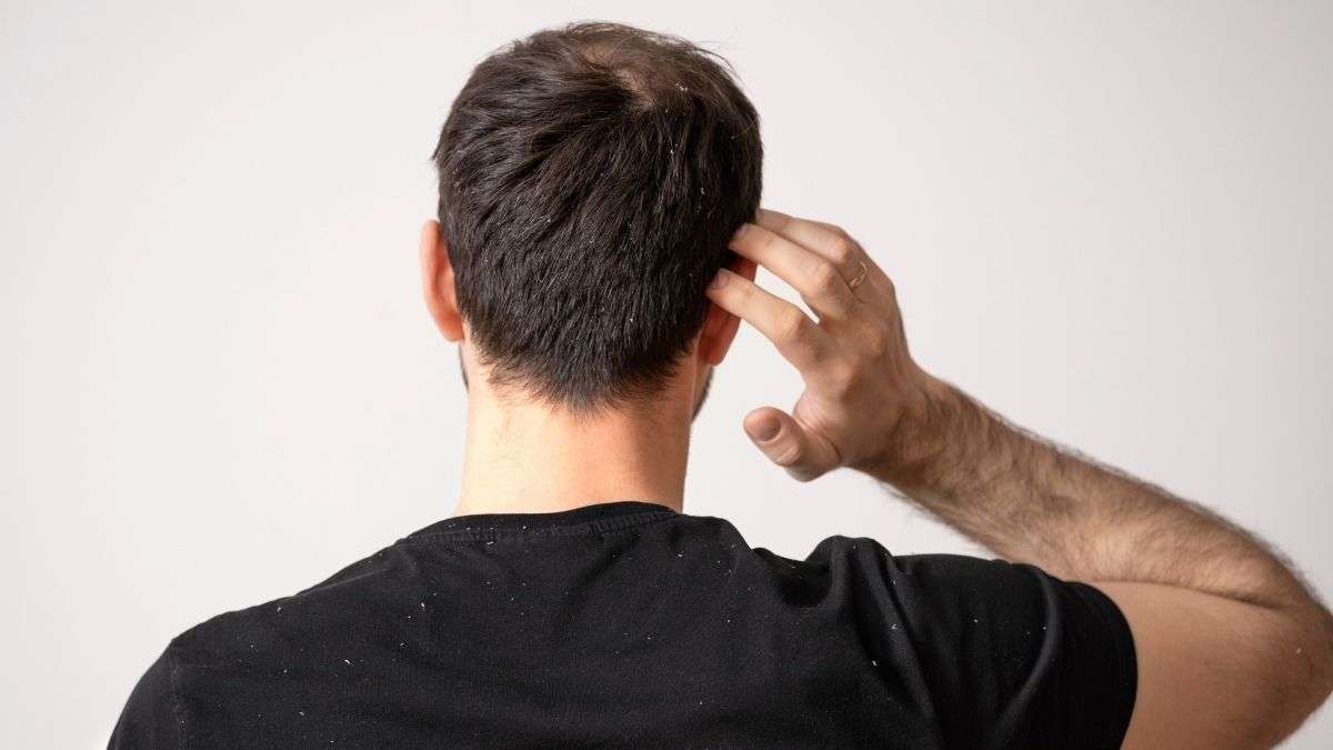 Winter dandruff and hair fall: Dermatologist explains causes and fixes ...