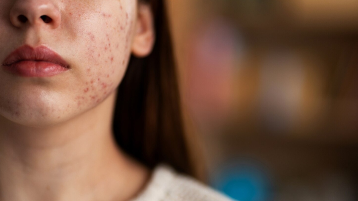 Are your breakouts worse in winter? Here's what dermatologists want you ...