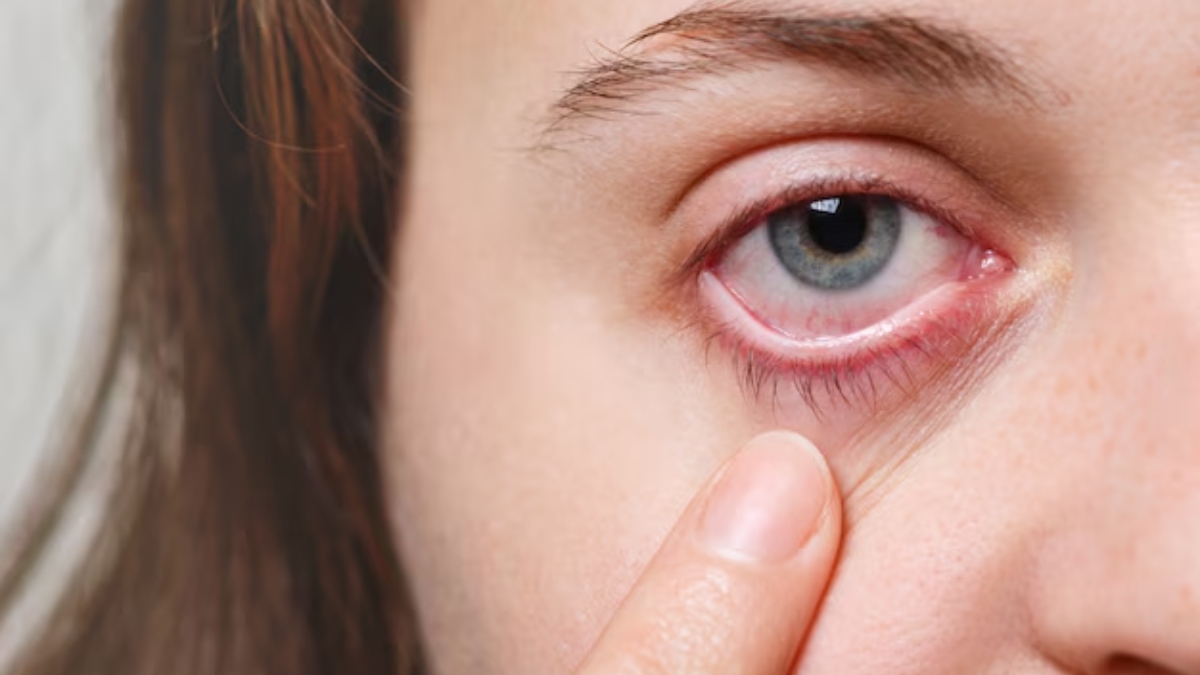 Dry eye syndrome during winter: Tips to take care of your eyes when ...