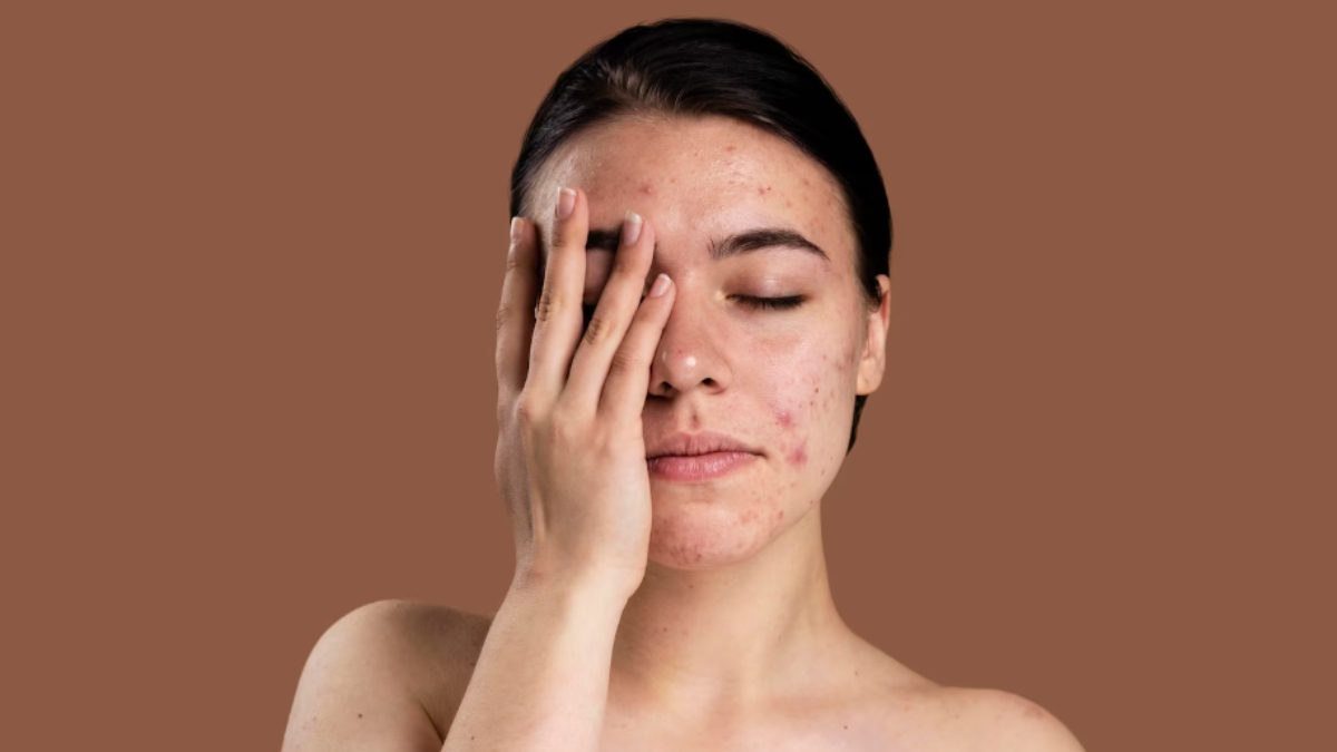 How to control acne and pigmentation naturally: Dermatologist-backed ...