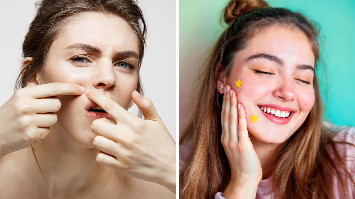 Pimple patches: Just hype or actually impactful? A dermatologist ...