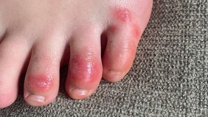 ‘COVID toes,’ other rashes latest possible rare virus signs | World ...