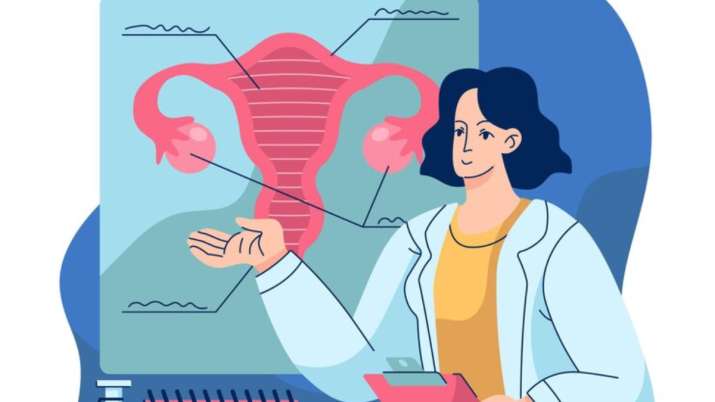 Chocolate Cyst: What is endometriotic cyst and its effects on fertility ...