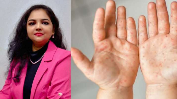 HFMD cases increase rapidly in kids; know causes, symptoms, and ...