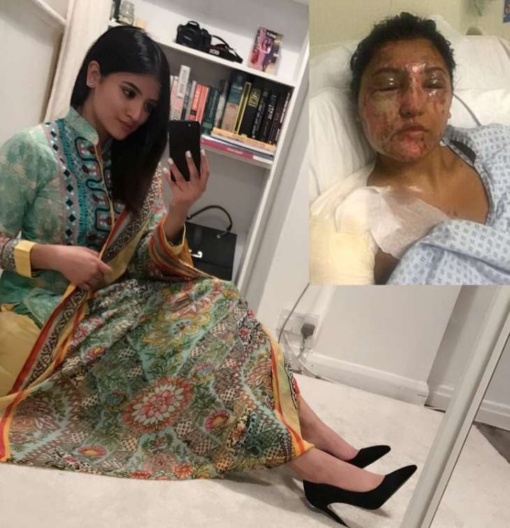 21-year-old London model whose face was ‘melted’ in an acid attack ...