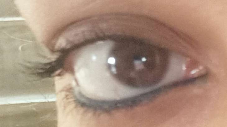 Delhi 3 live botflies removed from American woman's eye at Fortis ...