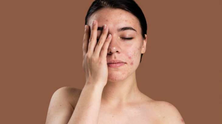 Facing itchy rashes due to exposure to the sun? Know what is the ...