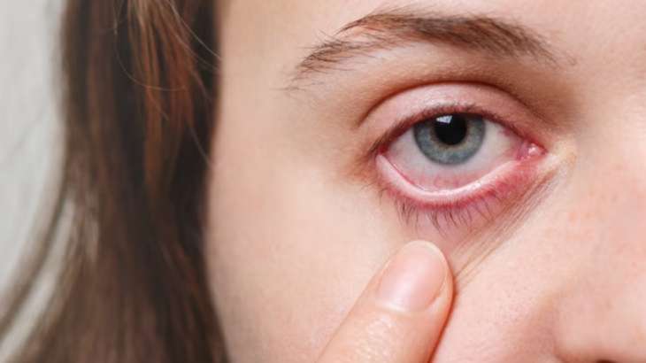 Eye Flu aka Conjunctivitis cases rise in Delhi, doctors advise to maintain hygiene | Eye News ...