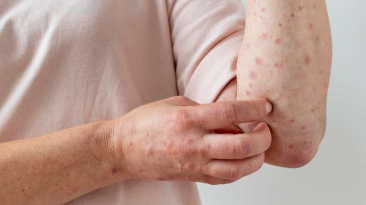 Clade 9: New variant of chickenpox virus detected in India, know ...