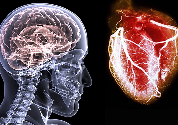 Brain attacks as serious as heart attacks: Expert | Lifestyle News ...
