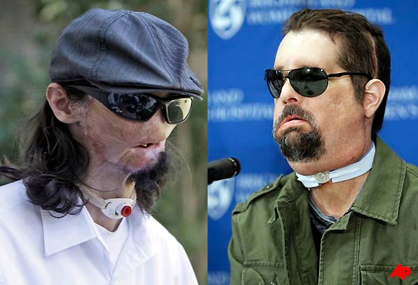 First Full Face Transplant In US | World News – India TV