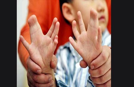 Chinese Boy Has 15 Fingers, 16 Toes | World News – India TV