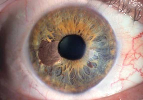 10,000 Indians diagnosed with eye cancer each year | India News – India TV