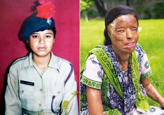 Acid Burn Victims Before And After