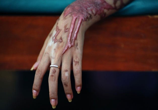 Centre to states:Give compensation to acid attack victims fast ...