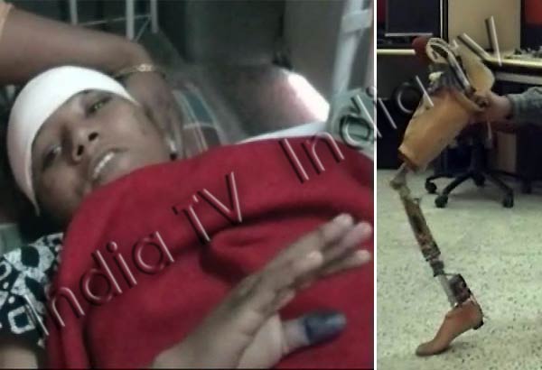 Lucknow Doctors Perform Surgery On Arunima's Severed Leg | India News ...