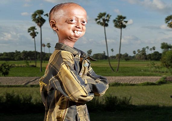 Real life Auro: A 14-year-old boy in Bihar looks like a 110-year-old ...