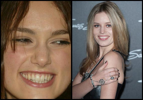 Flaunt your imperfect smile | Hollywood News – India TV