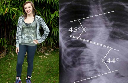 UK Girl With Curved Spine Does Breakdance After Undergoing Yoga | World ...